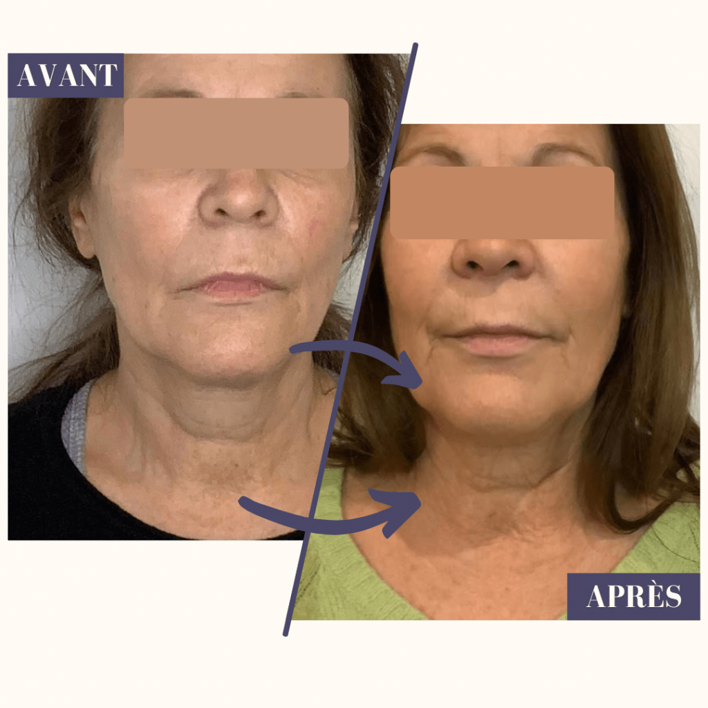 Les fils tenseurs APTOS | Médecine esthétique | Centre MIAA